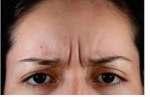 Vertical Forehead Lines Treatment | Cosmetic Injectables