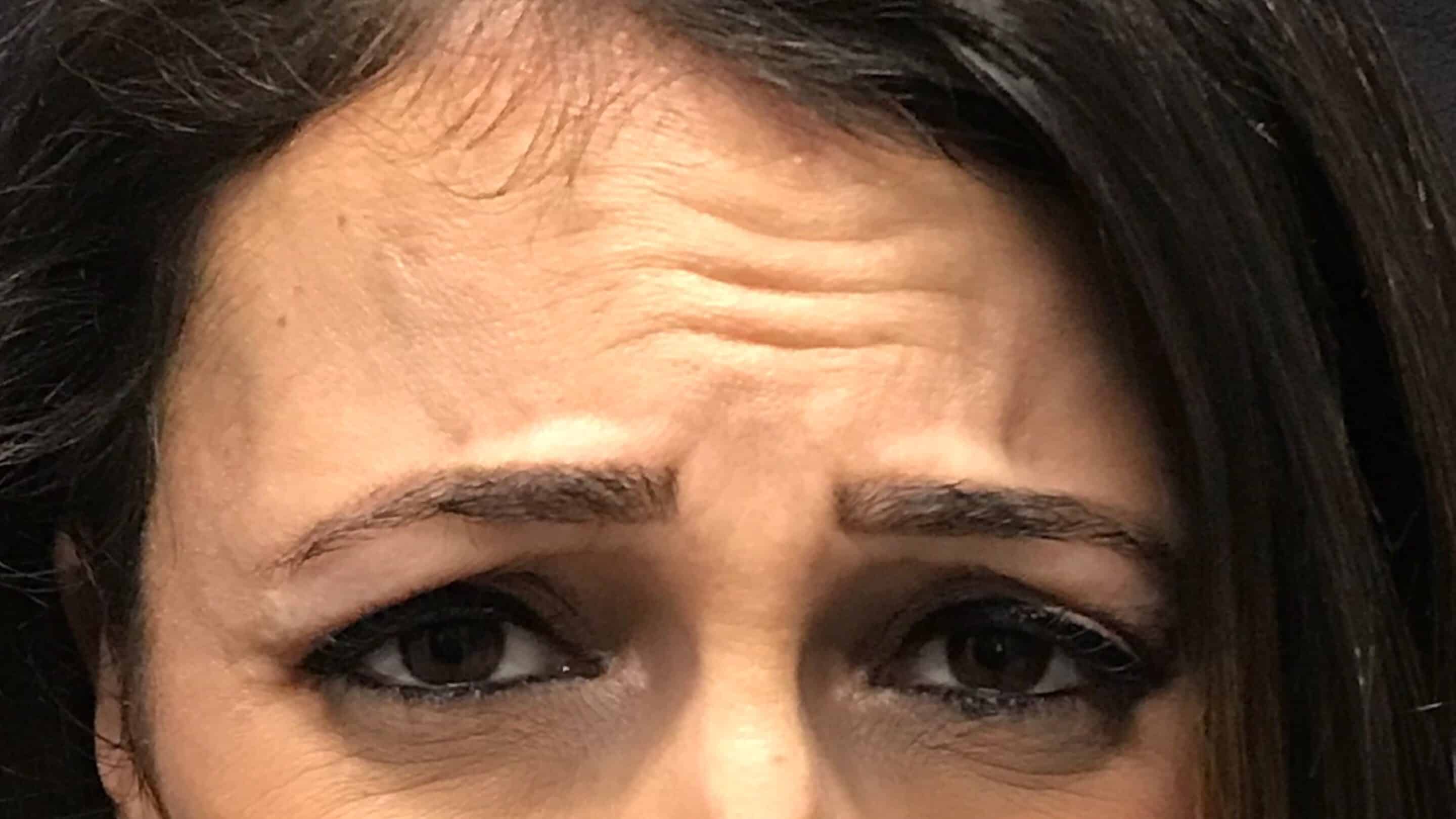 Forehead & Frown - Cosmetic Injectables Forehead & Frown