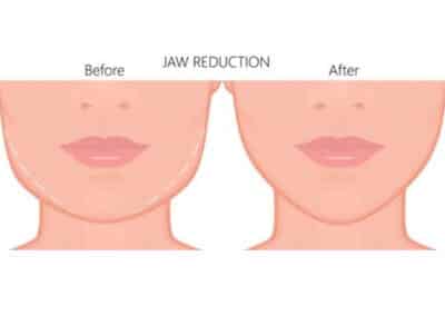 Botox For TMJ: Cost, Info, Results, Reviews | Sherman Oaks